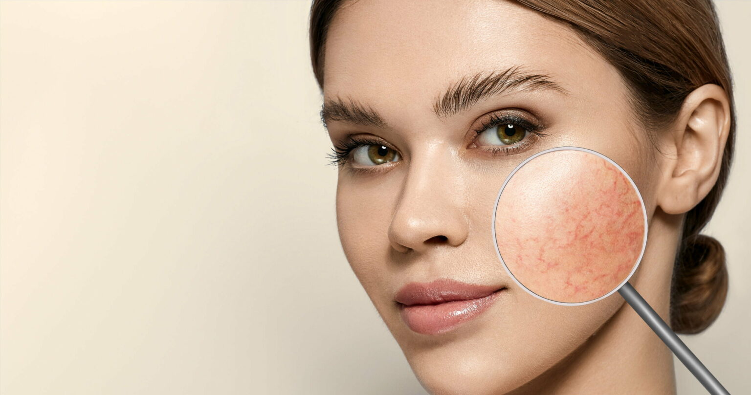 Sensitive Skin & Rosacea: Understanding Causes, Symptoms